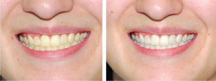 Spa Teeth Whitening - My Cosmetic Solutions