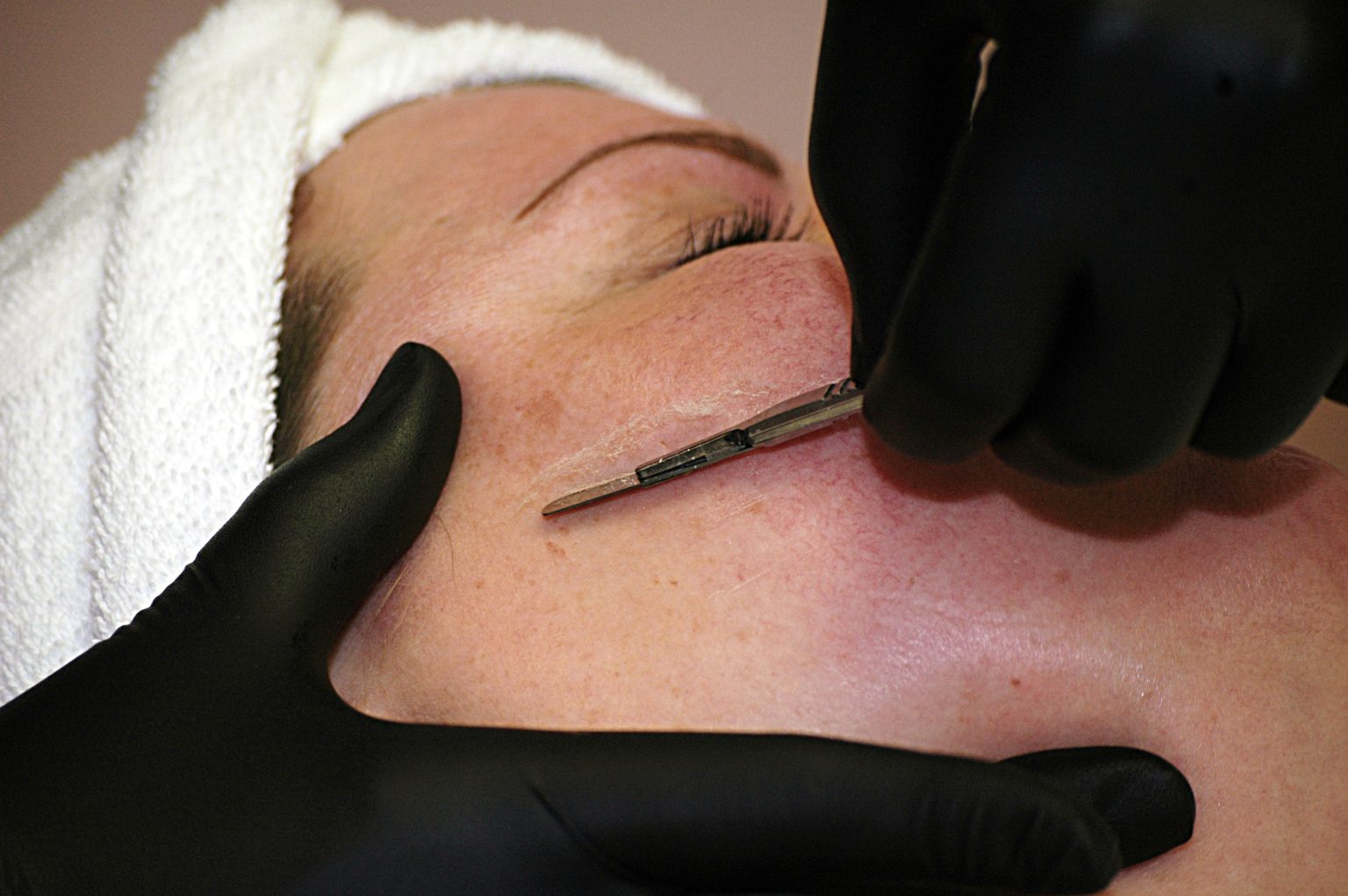 Dermaplaning in Pittsburgh, PA | My Cosmetic Solutions
